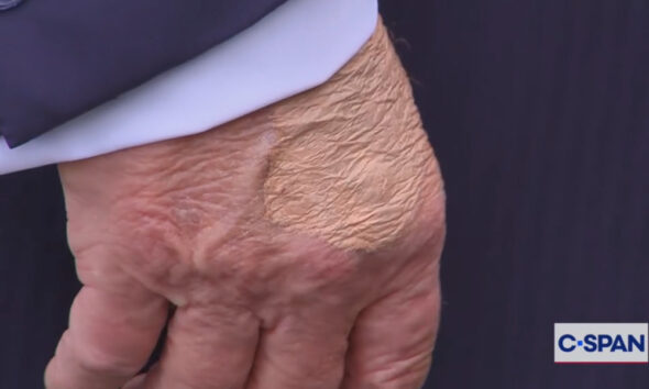 White House physician addresses Trump’s leg swelling and hand bruising ...